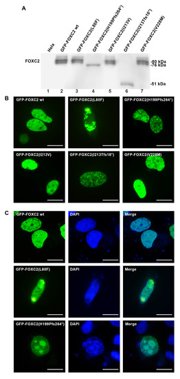 FOXC2 Disease Mutations Identified in Lymphedema Distichiasis Patients ...