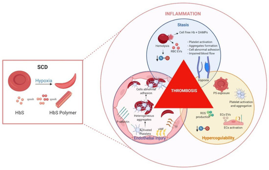 Sickle Cell Disease: A Paradigm for Venous Thrombosis Pathophysiology