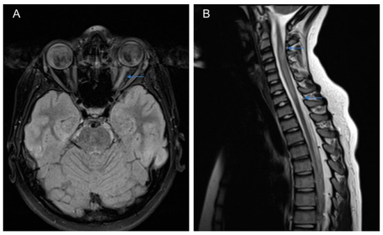 Hematopoietic Stem Cell Transplantation in Neuromyelitis Optica ...