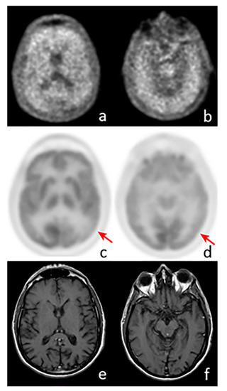 Positron Emission Tomography (PET) and Neuroimaging in the Personalized ...