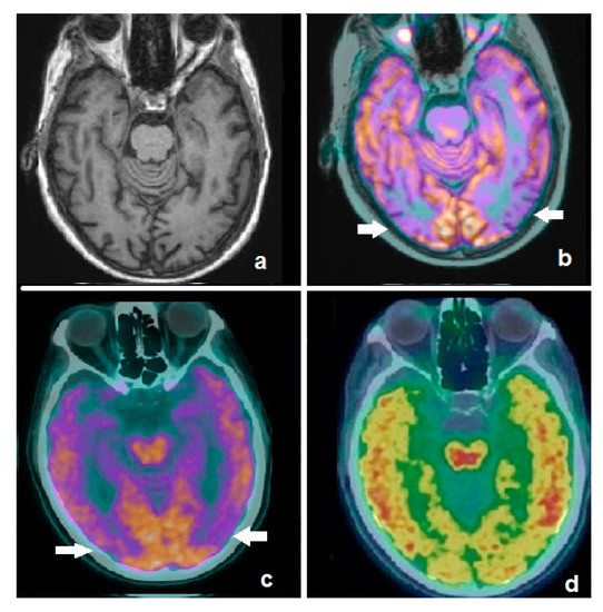 Positron Emission Tomography (PET) and Neuroimaging in the Personalized ...