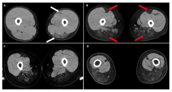 Early-Onset Infantile Facioscapulohumeral Muscular Dystrophy: A Timely ...