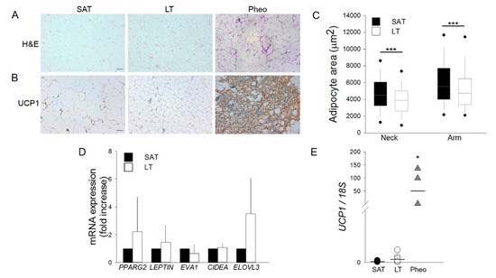 IJMS | Special Issue : Lipodystrophy and Fat Redistribution: From ...