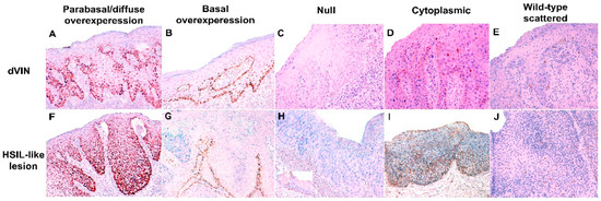 p53 Immunohistochemical Patterns in HPV-Independent Squamous Cell ...