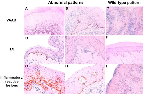 Ijms Free Full Text P53 Immunohistochemical Patterns In Hpv