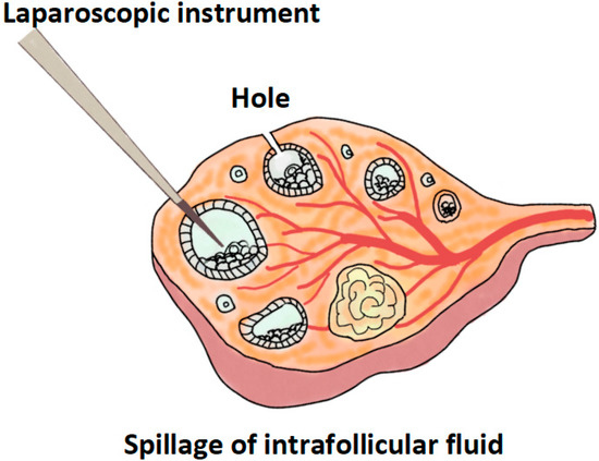 Molecular Mechanisms of Laparoscopic Ovarian Drilling and Its ...
