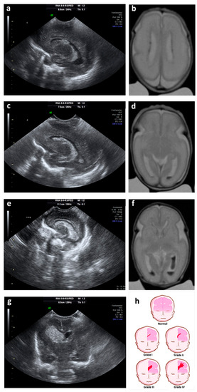 Ijms Free Full Text Germinal Matrix Intraventricular Hemorrhage Of