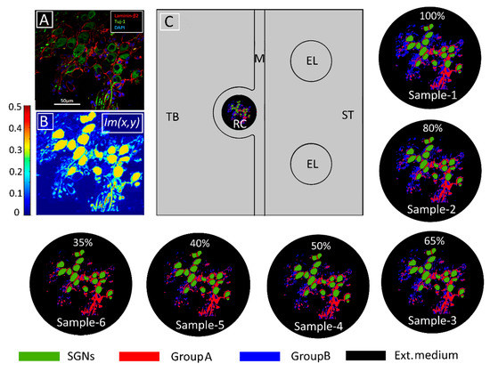 Neural Tissue Degeneration in Rosenthal’s Canal and Its Impact on ...