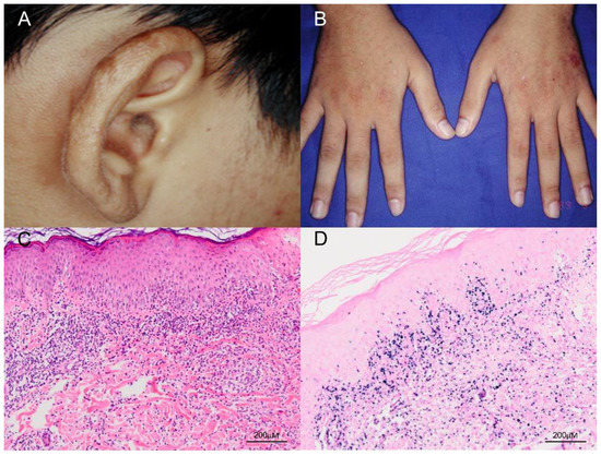Hydroa Vacciniforme and Hydroa Vacciniforme-Like Lymphoproliferative ...