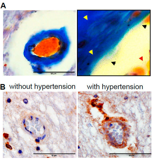 Vasa Vasorum Lumen Narrowing in Brain Vascular Hyalinosis in Systemic ...