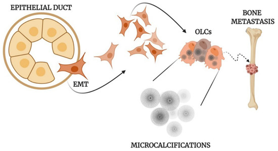 Molecular Aspects and Prognostic Significance of Microcalcifications in ...
