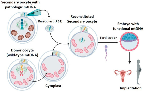 IJMS | Free Full-Text | Mitochondrial DNA Replacement Techniques to ...