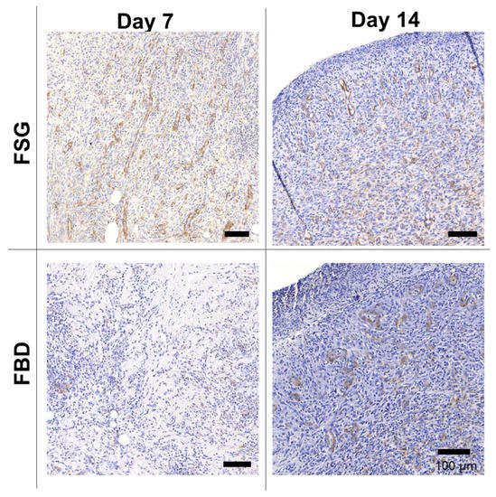 Accelerated Wound Closure of Deep Partial Thickness Burns with ...
