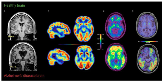 Imaging Techniques in Alzheimer’s Disease: A Review of Applications in ...