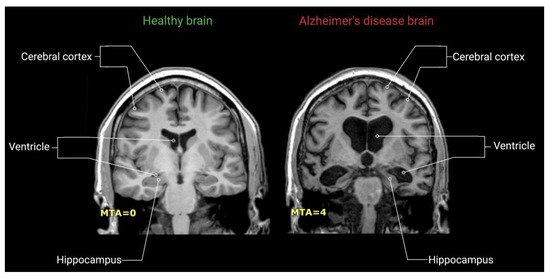 Imaging Techniques in Alzheimer’s Disease: A Review of Applications in ...