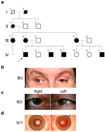 EPHA2 Segregates with Microphthalmia and Congenital Cataracts in Two ...