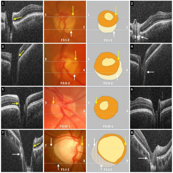 Choroidal Crescent Vs Scleral Crescent