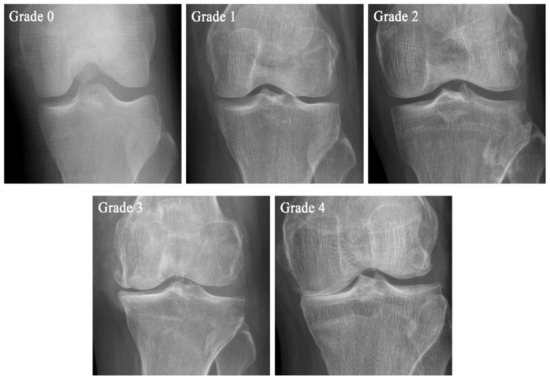 Recent Updates of Diagnosis, Pathophysiology, and Treatment on ...