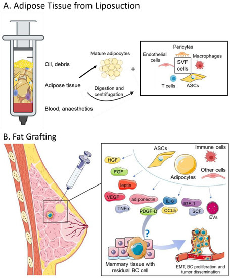 IJMS | Free Full-Text | Lipofilling in Breast Oncological Surgery: A ...