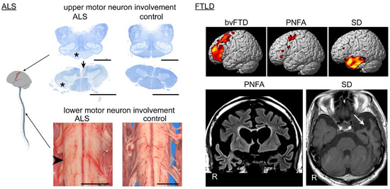 Pathway from TDP-43-Related Pathology to Neuronal Dysfunction in ...
