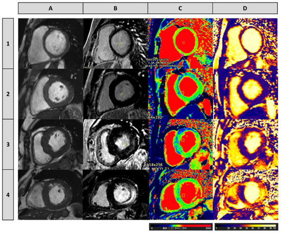 Fabry Disease and the Heart: A Comprehensive Review