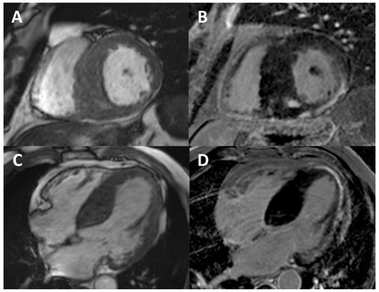 Fabry Disease and the Heart: A Comprehensive Review