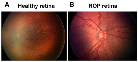 Concurrent Physiological and Pathological Angiogenesis in Retinopathy ...