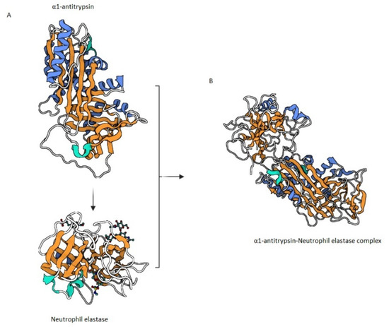 Protease–Antiprotease Imbalance in Bronchiectasis
