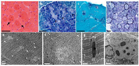 Inherited Defects of the ASC-1 Complex in Congenital Neuromuscular Diseases
