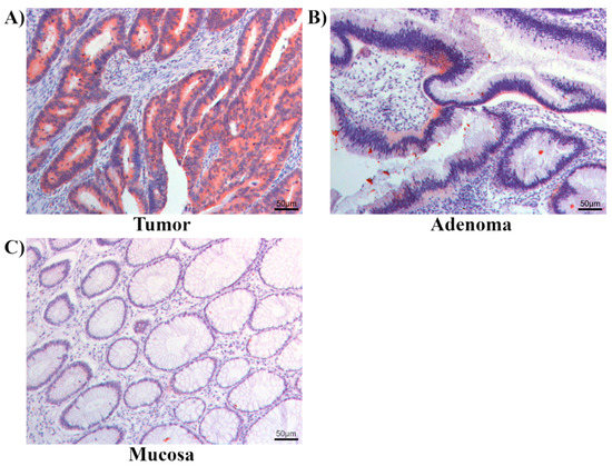 Granulin: An Invasive and Survival-Determining Marker in Colorectal ...
