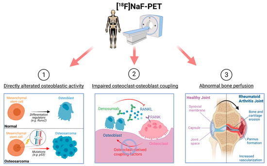 18F-Sodium Fluoride PET as a Diagnostic Modality for Metabolic ...