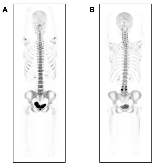 18F-Sodium Fluoride PET as a Diagnostic Modality for Metabolic ...
