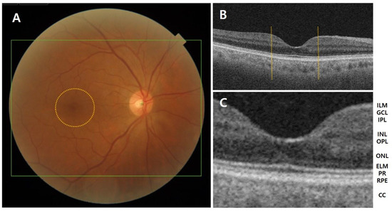 Complement System and Potential Therapeutics in Age-Related Macular ...