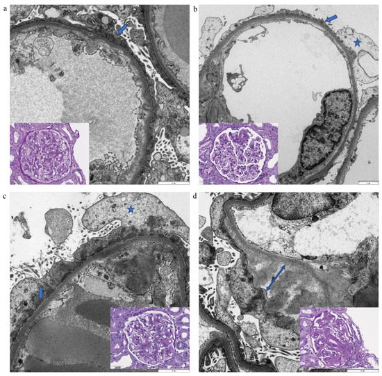 CD73 Overexpression in Podocytes: A Novel Marker of Podocyte Injury in ...