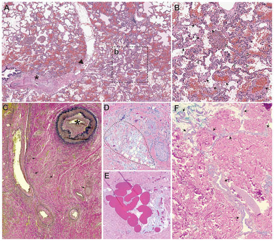 IJMS | Free Full-Text | Arteriovenous Malformations—Current ...