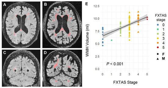 Brain Atrophy and White Matter Damage Linked to Peripheral Bioenergetic ...