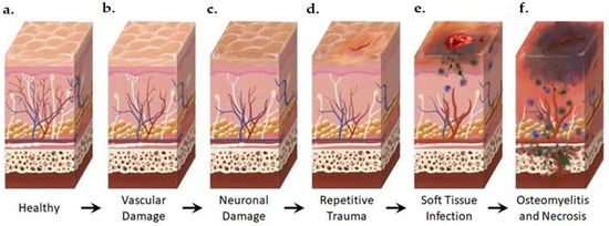 Pathophysiology and Molecular Imaging of Diabetic Foot Infections