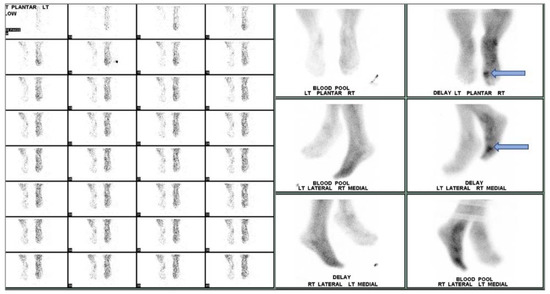 Pathophysiology and Molecular Imaging of Diabetic Foot Infections