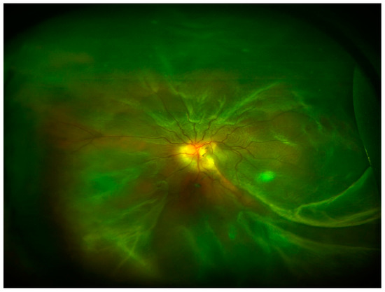 Understanding Drivers of Ocular Fibrosis: Current and Future ...