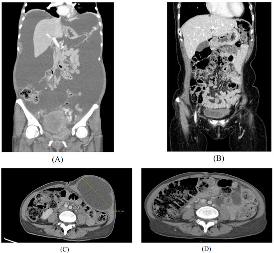 Antitumor Effects of Selenium