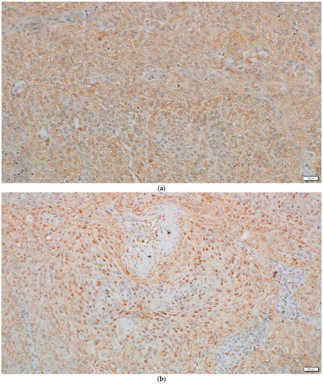 Decoding the Role of DVL1 in Intracranial Meningioma