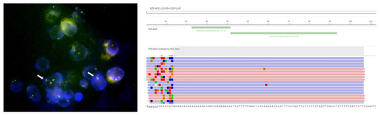 Deepening the Knowledge of ROS1 Rearrangements in Non-Small Cell Lung ...