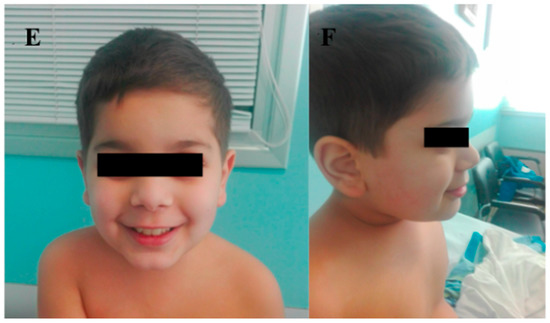 New Candidates for Autism/Intellectual Disability Identified by Whole ...