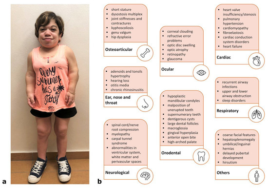 Mucopolysaccharidosis Type VI, an Updated Overview of the Disease