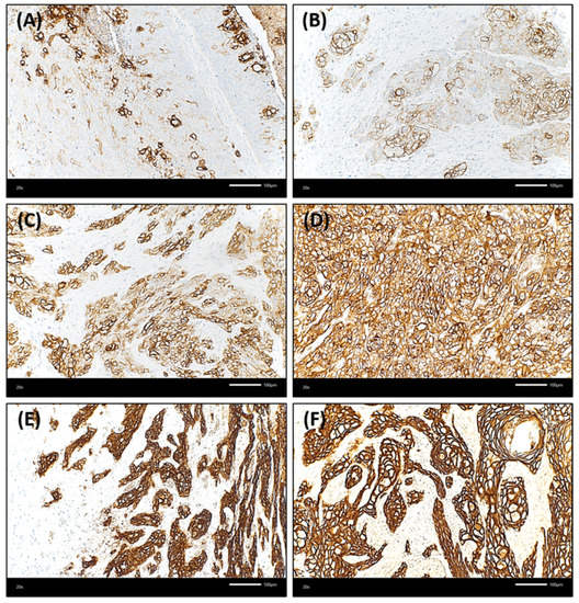 Impact of Spatially Heterogeneous Trop-2 Expression on Prognosis in ...