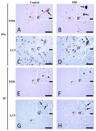 LC3/FtMt Colocalization Patterns Reveal the Progression of FtMt ...