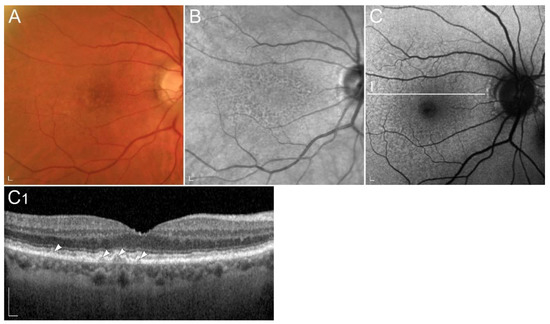 The Role of Vitamin A in Retinal Diseases