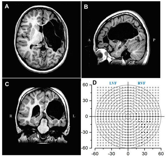 Normal Retinotopy in Primary Visual Cortex in a Congenital Complete ...