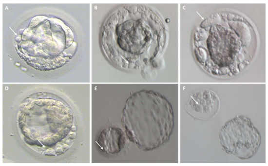 Cellular and Molecular Nature of Fragmentation of Human Embryos