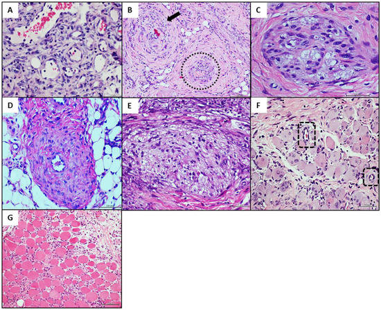 IJMS | Free Full-Text | Intralesional Infiltrations of Arteriosclerotic ...